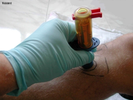 1999-2003: Bone Injector Gun – EMS Museum